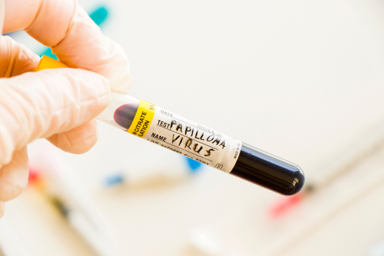 HPV la femei - informatii despre cauze, tratament si complicatii