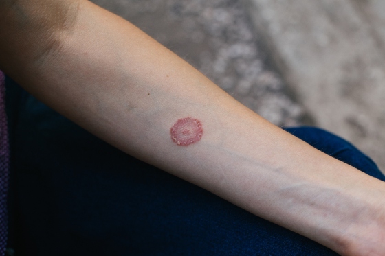 Tinea corporis (dermatofitoza) – cauze, simpotome, tratament